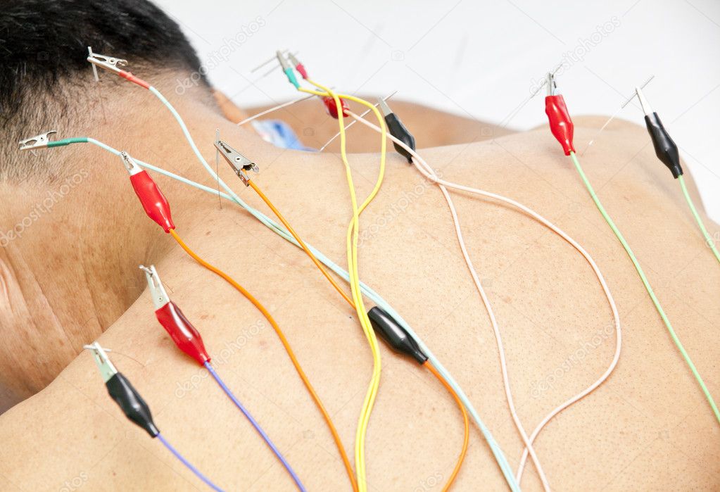 Followup Acupuncture Visit – Catya Body Sculpting LLC